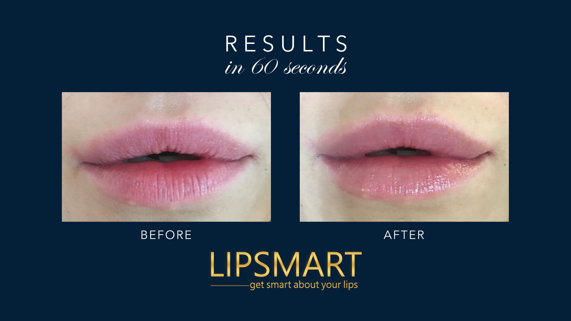 LIPSMART® - Obi Bioaesthetic Institute