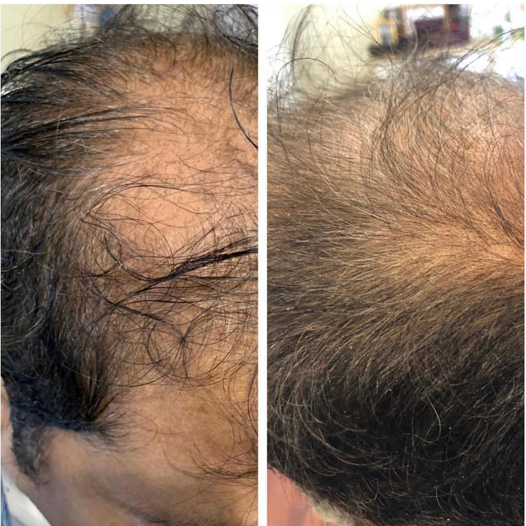 Synthetic Hair Growth Factor - Obi Bioaesthetic Institute