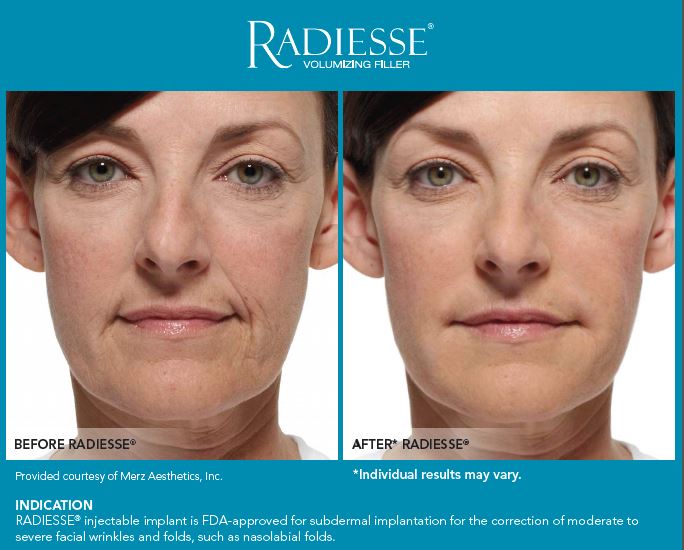 Radiesse® Plus in Jacksonville Beach & Ponte Vedra - Obi Institute