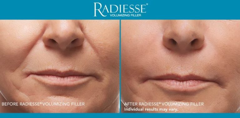 Radiesse® Plus in Jacksonville Beach & Ponte Vedra - Obi Institute