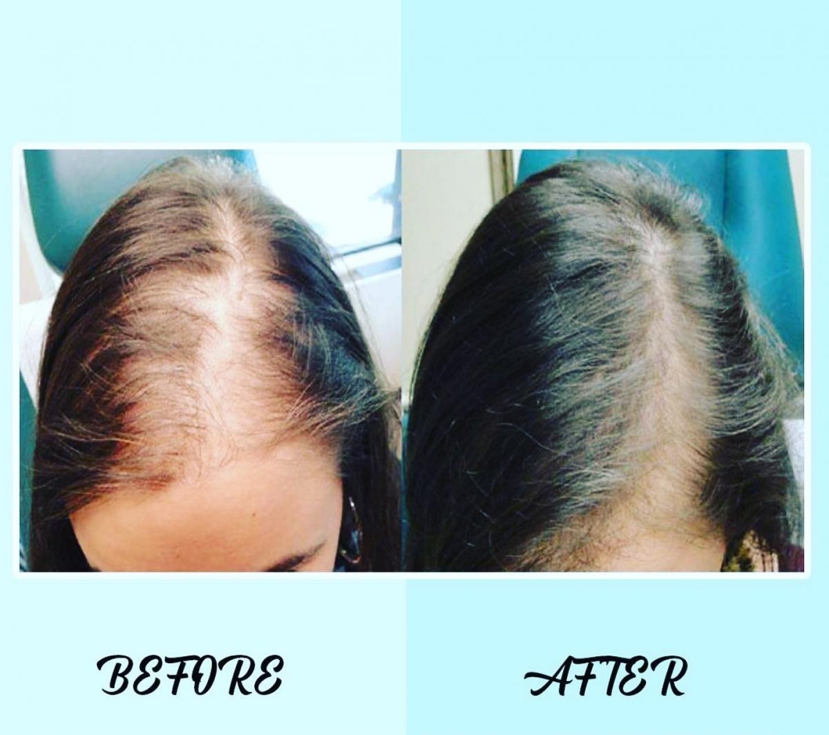 Women Hair Growth Stimulation Treatments & Procedures